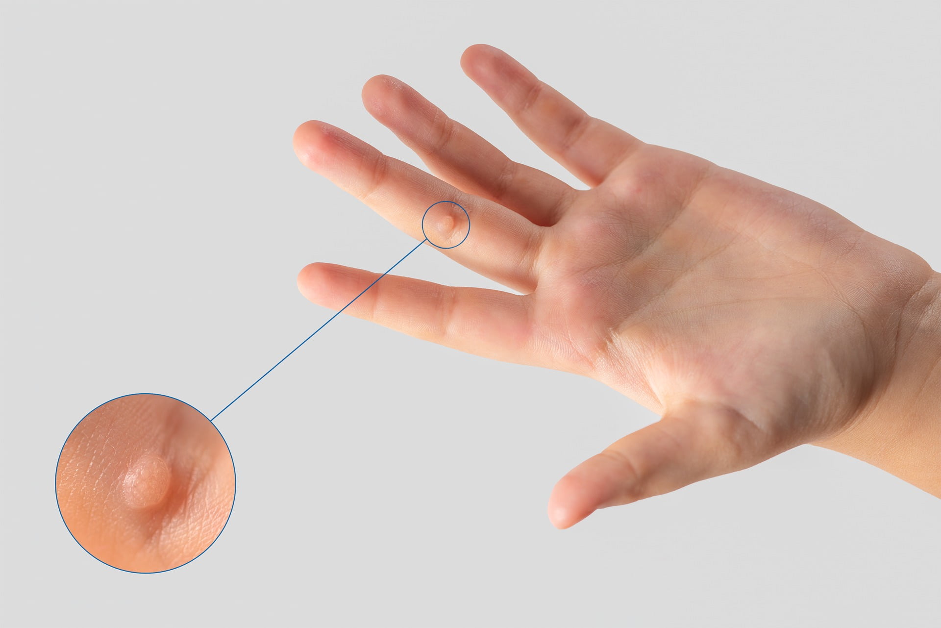 Wart Removal Treatment Near Me in Pune @ Affordable Prices