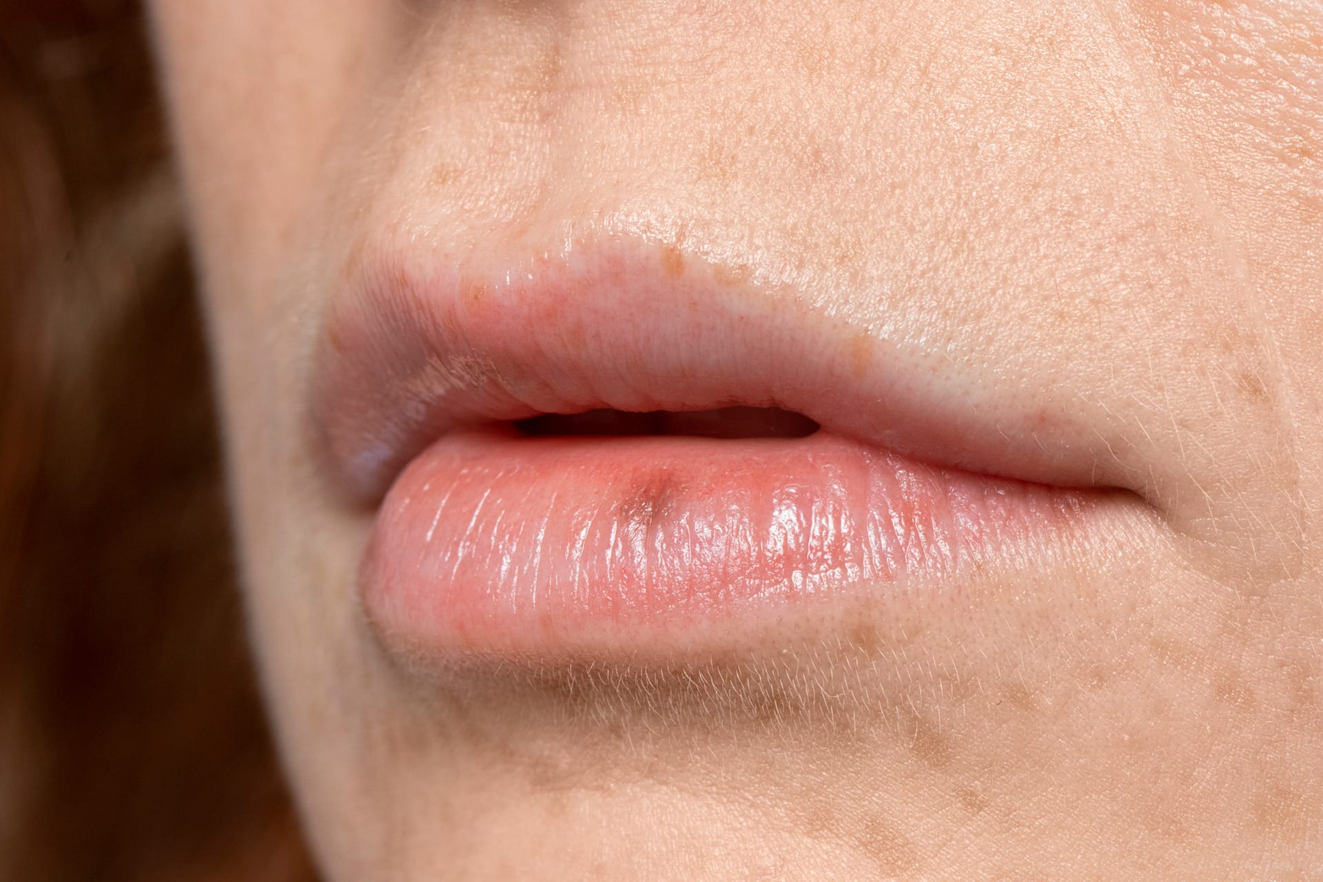 How to Treat Lip Hyperpigmentation | Causes & Best Remedies