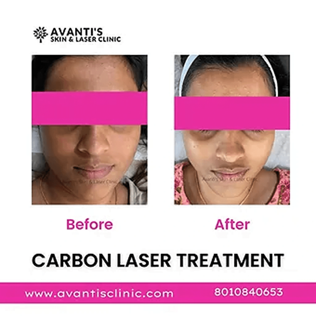 Glutathione for Skin Lightening: What It Can and Cannot Do