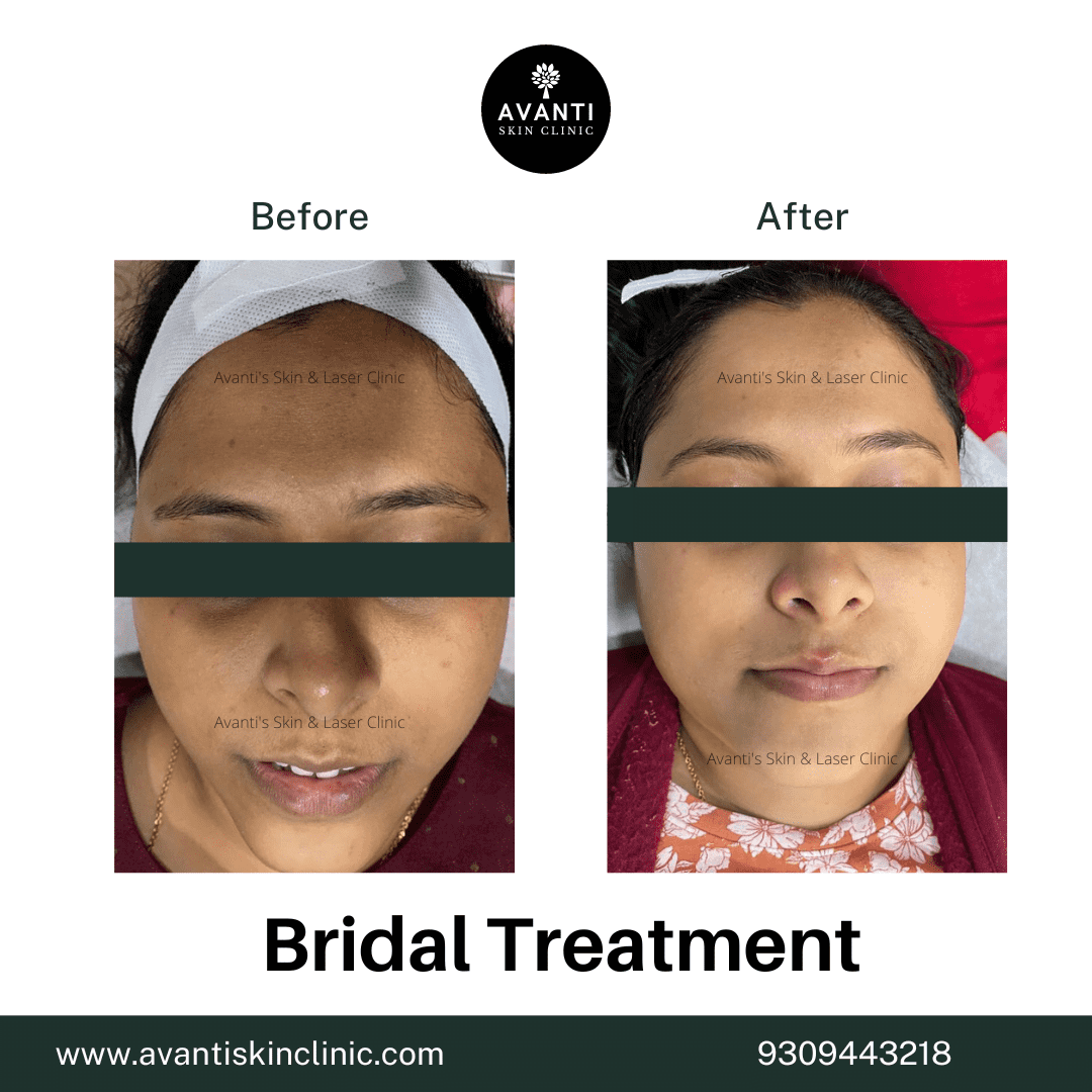 Is Azelaic Acid Good for Melasma? Benefits & Limits