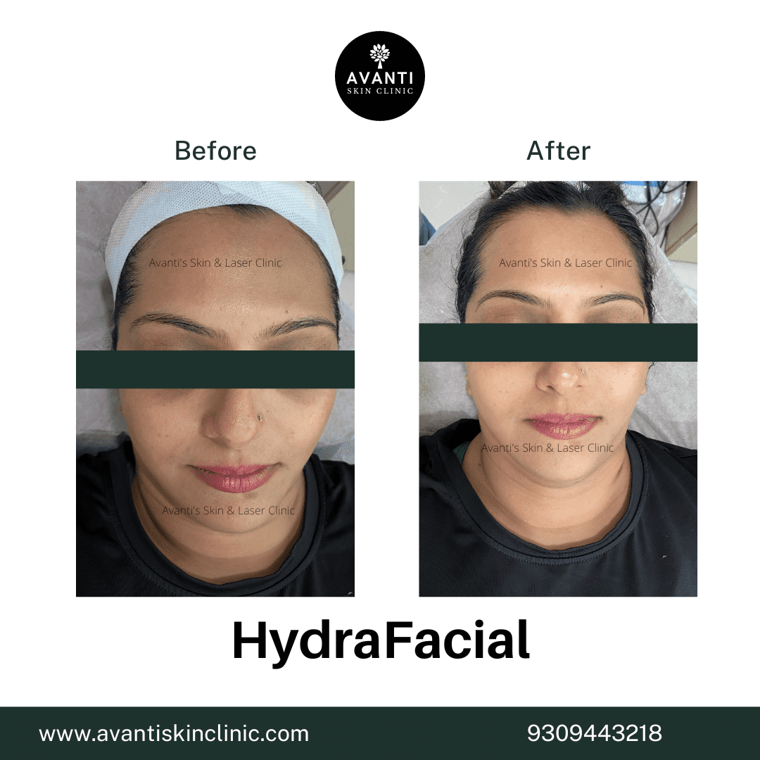 Is Azelaic Acid Good for Melasma? Benefits & Limits