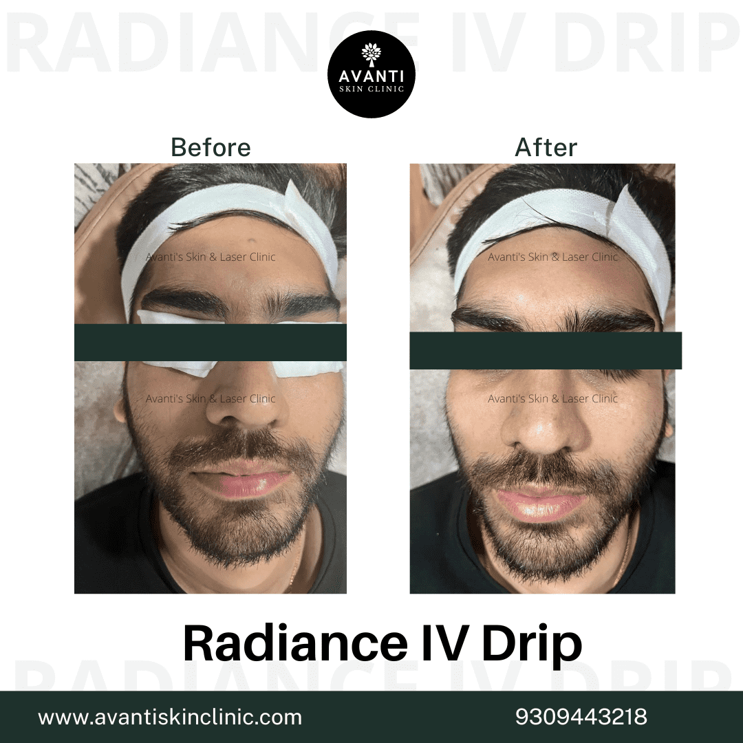 When Should Bride & Groom Do a Facial Before Marriage?